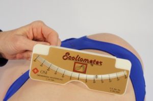 How To Spot Scoliosis: Using a scoliometer - Scolio-Pilates
