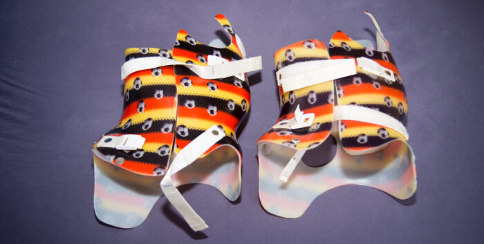 Scoliosis and Bracing - Scolio-Pilates