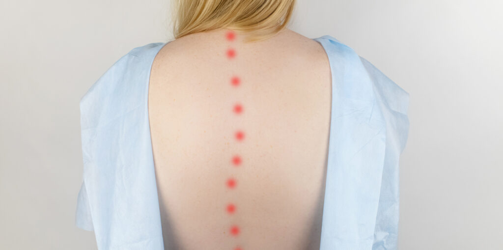 Scoliosis Surgery - Scolio-Pilates